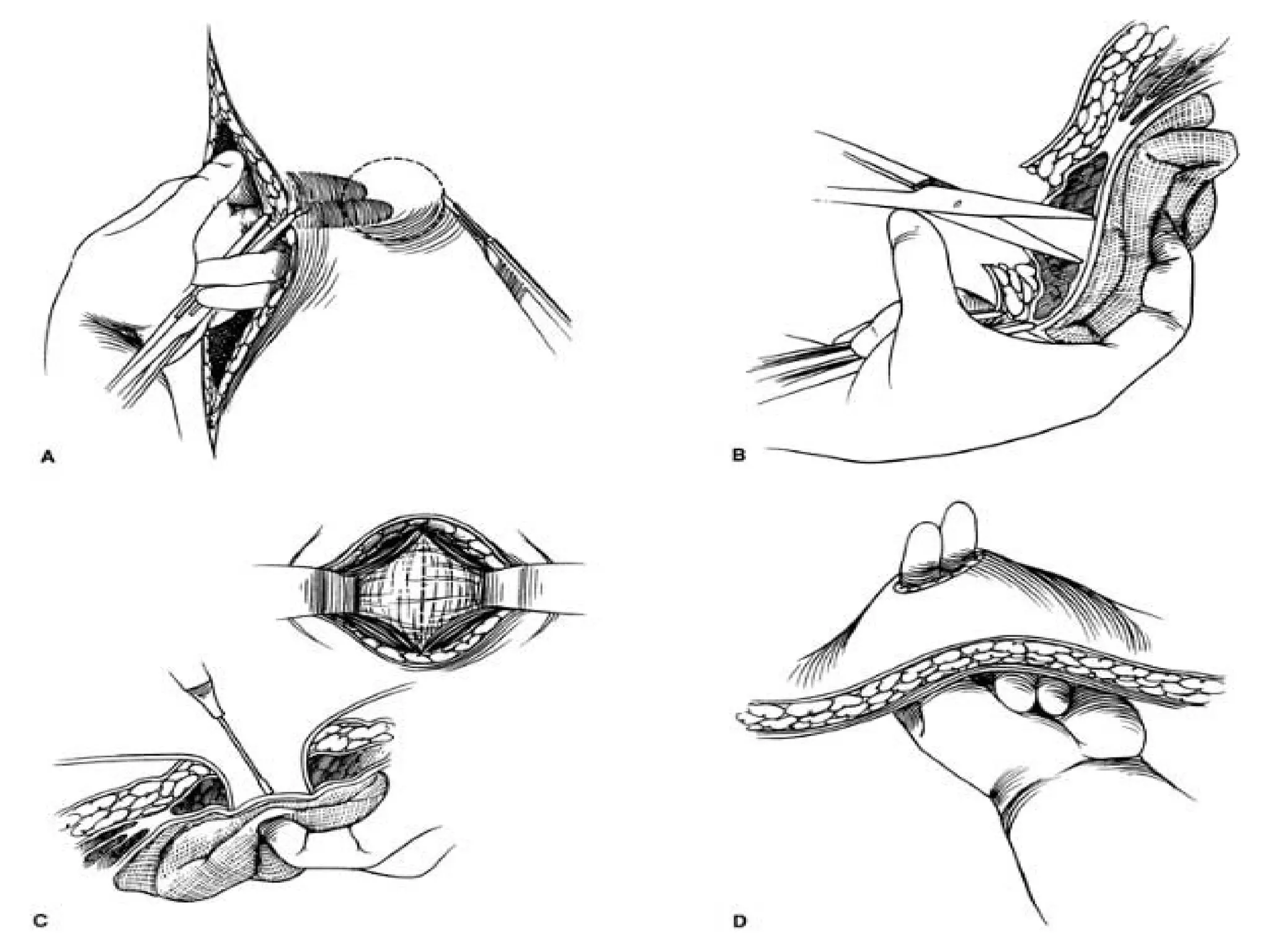 colostomy (Stoma surgery -- Gastrointestinal).pptx