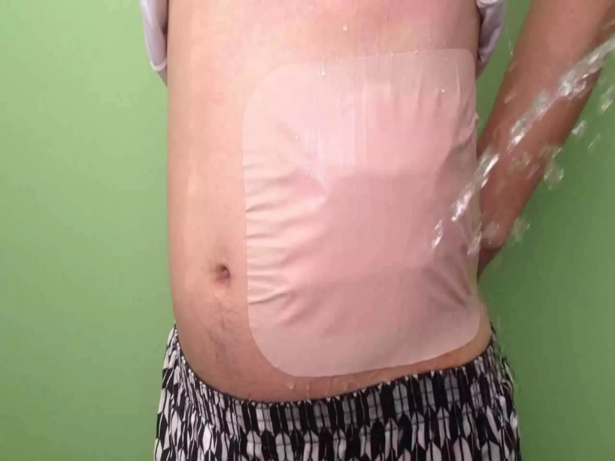 Colostomy care | PPTX