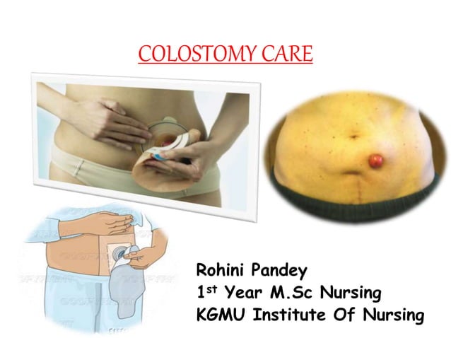 Colostomy care | PPTX