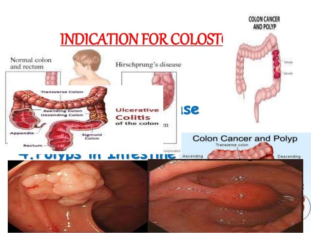 Colostomy care