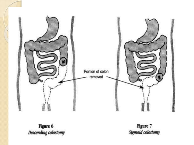 Colostomy care | PPTX