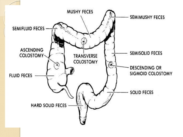 Colostomy care | PPTX