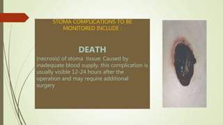 Colostomy care | PPTX