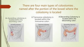 Colostomy care | PPT