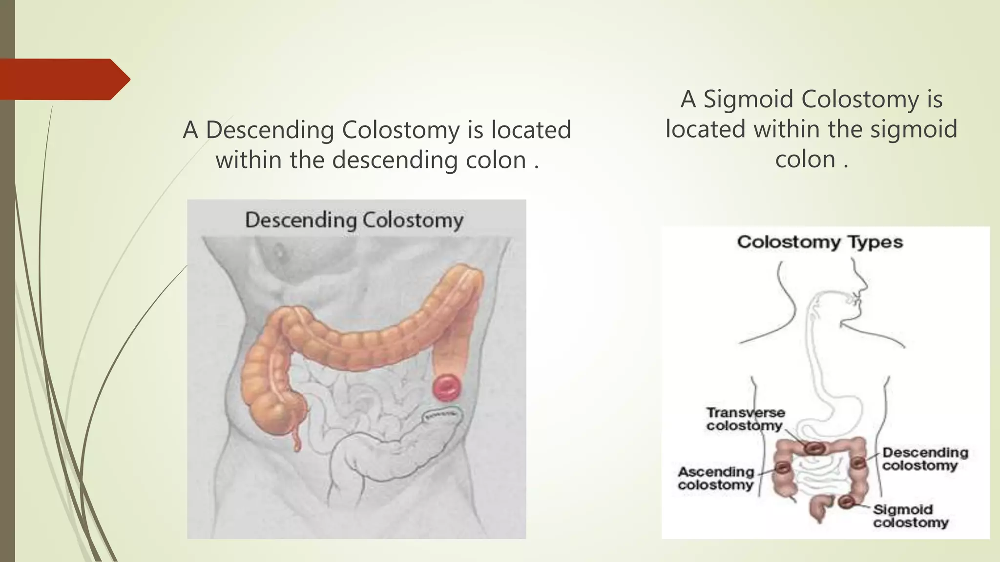 Colostomy care | PPTX