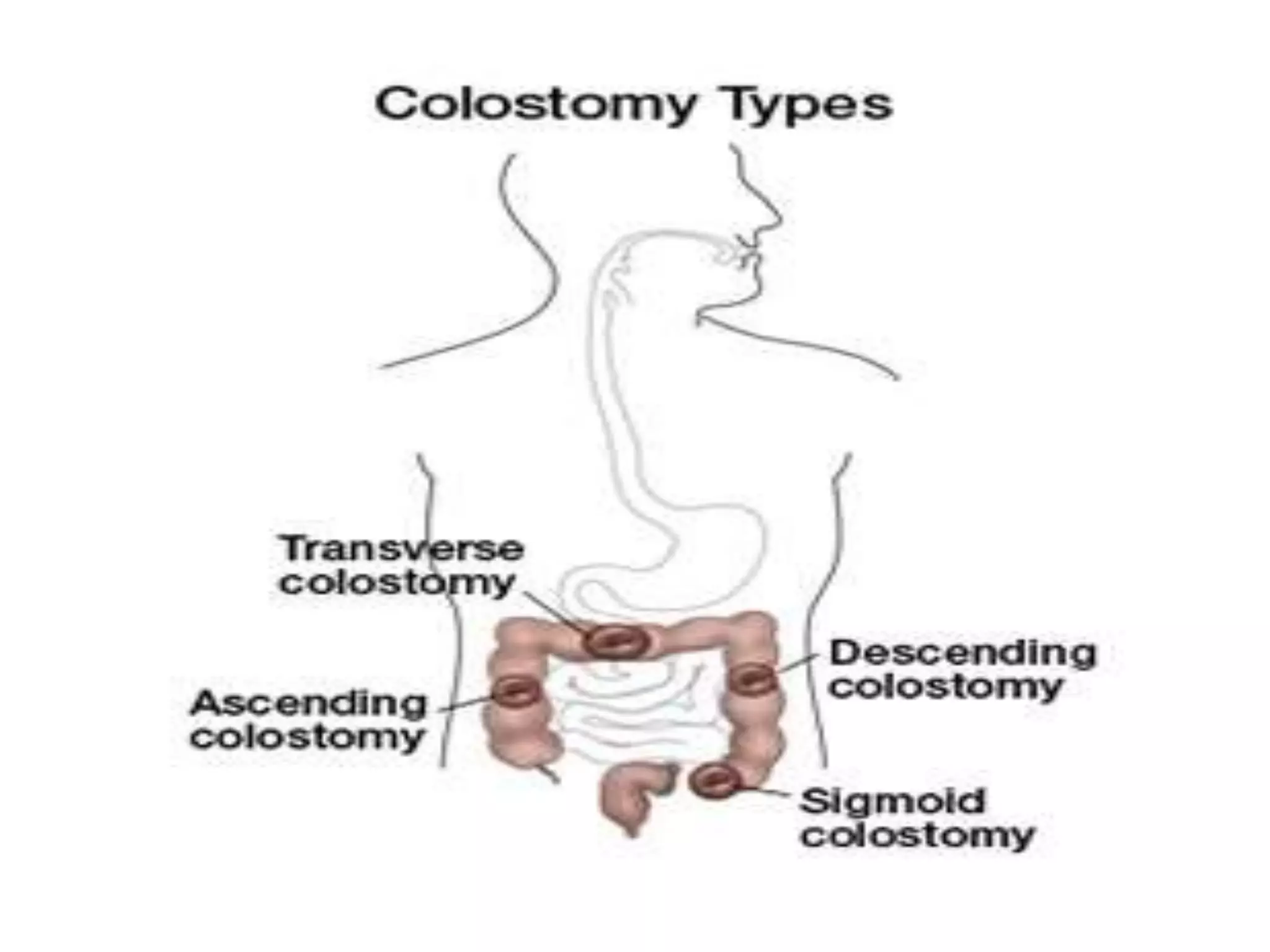 COLOSTOMY CARE.pptx
