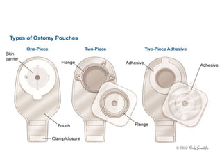 colostomy care APPLICATION PROCEDURE.pptx