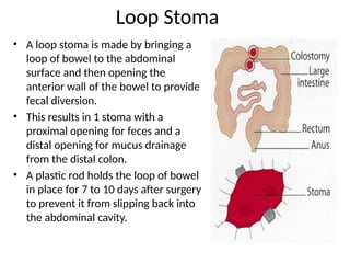 colostomy types , indications management and care | PPTX