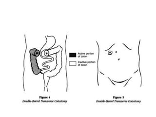 colostomy types , indications management and care | PPTX