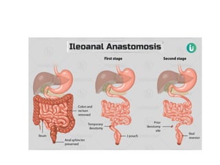 colostomy types , indications management and care | PPTX