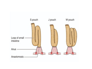 colostomy types , indications management and care | PPTX