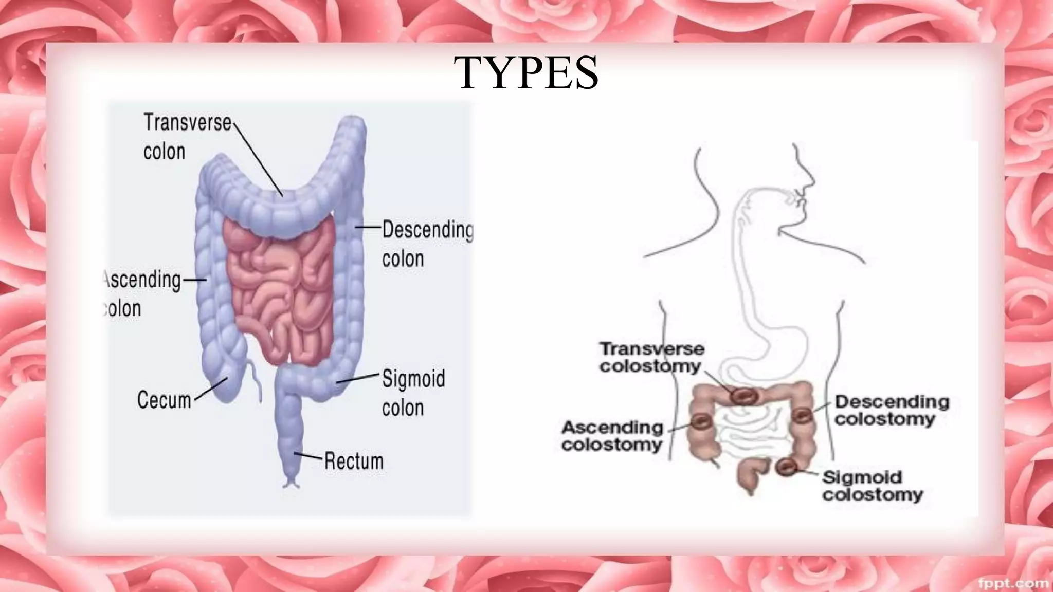 Colostomy care : Nursing management | PDF