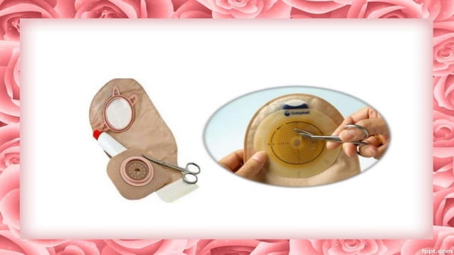 Colostomy care : Nursing management | PDF