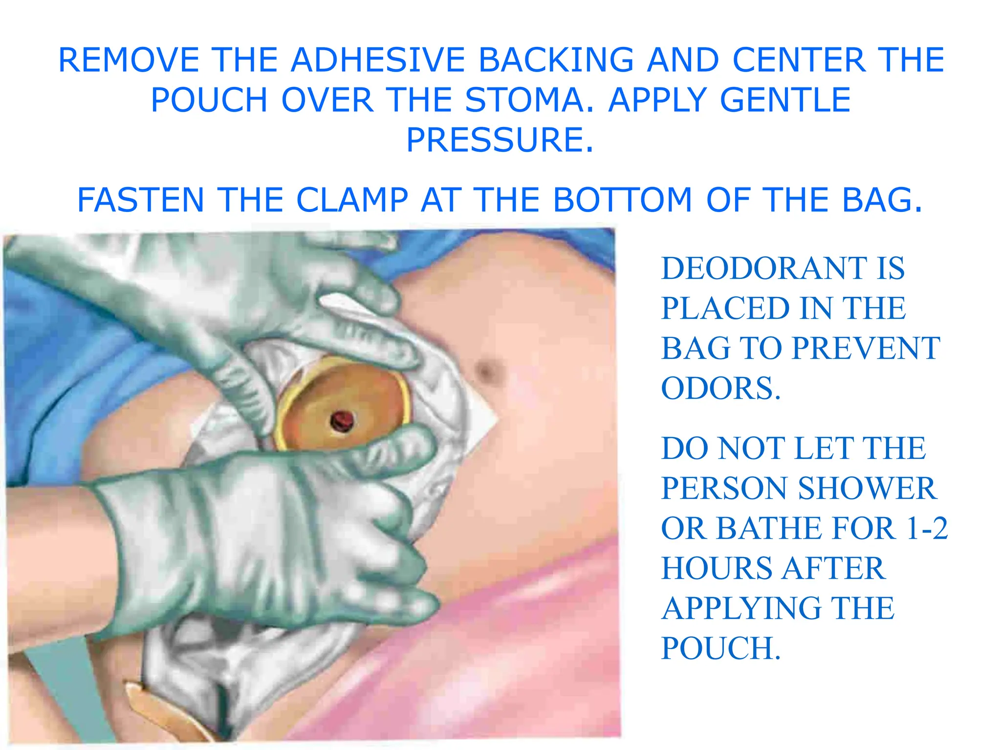 colostomy site and complication power point explanation | PPTX