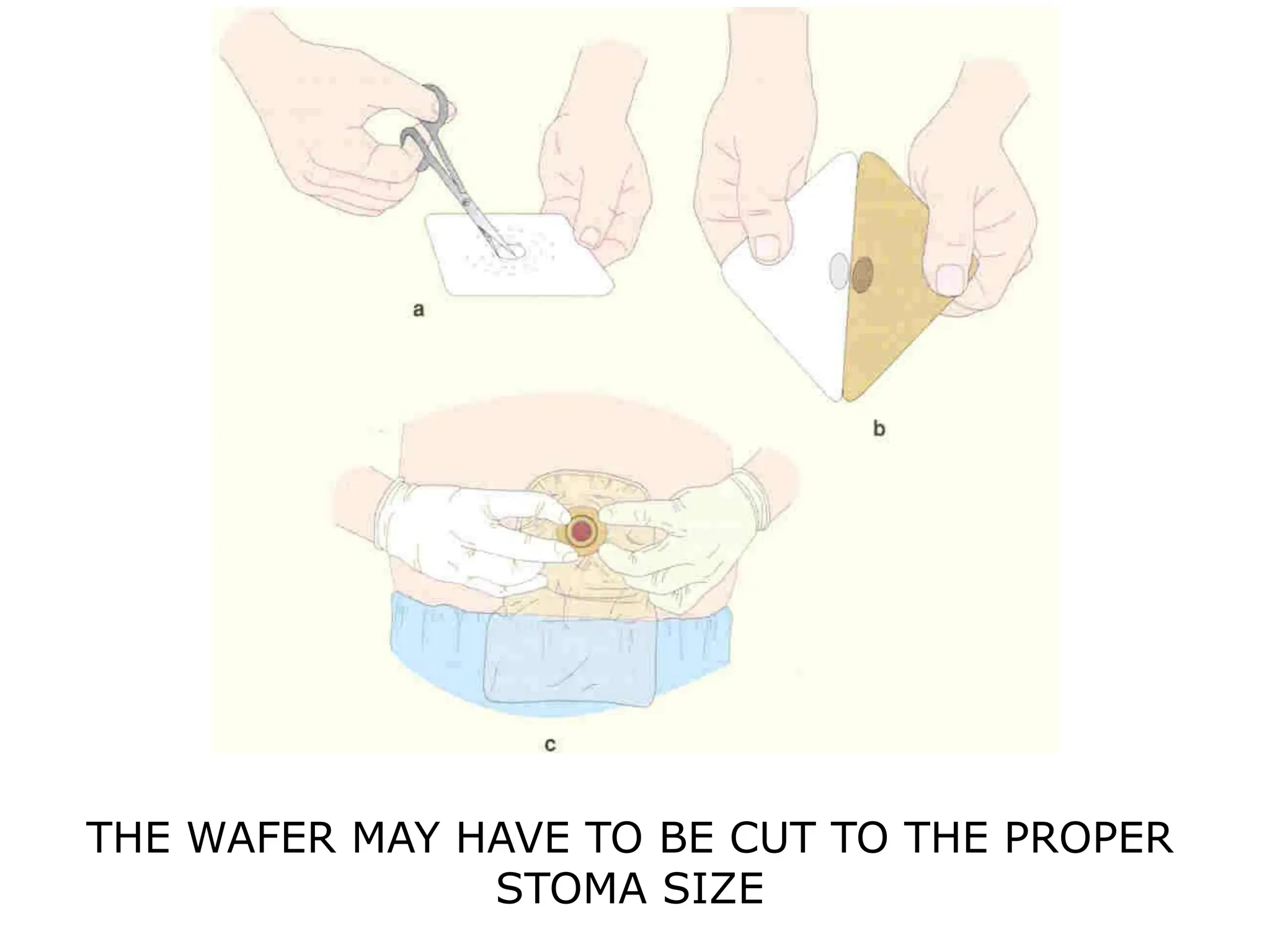 colostomy site and complication power point explanation | PPTX