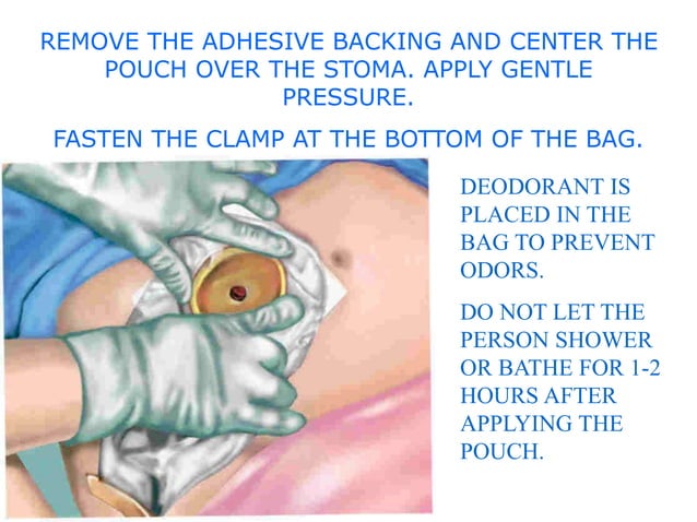 colostomy site and complication power point explanation | PPTX