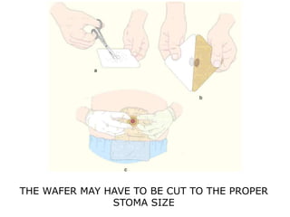 colostomy site and complication power point explanation | PPTX