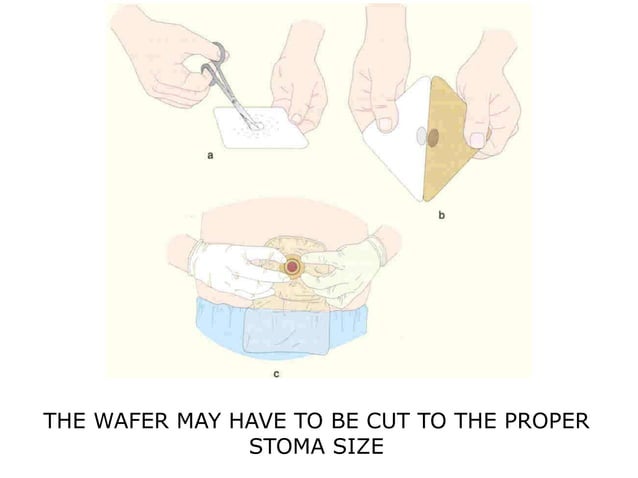colostomy site and complication power point explanation | PPTX