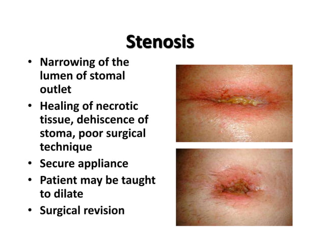 colostomy site and complication power point explanation | PPTX