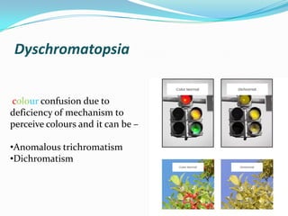 Color vision : introduction, classification, causes | PDF