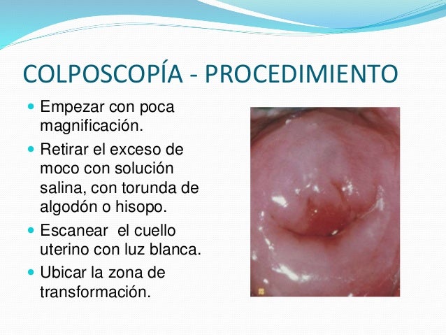 Colposcopia