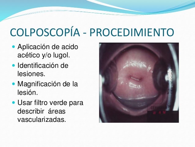 Colposcopia