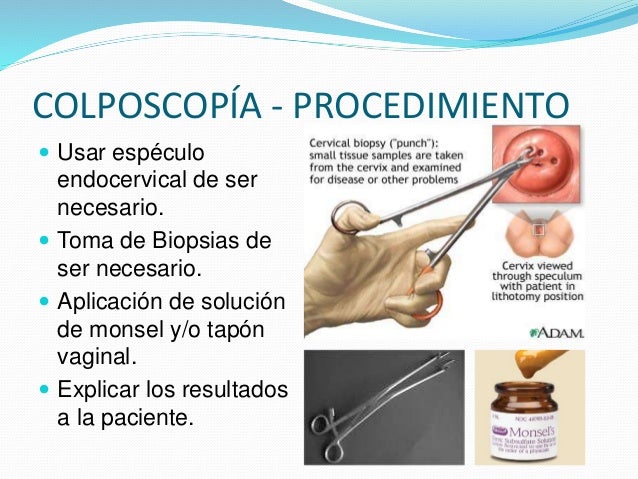 Colposcopia