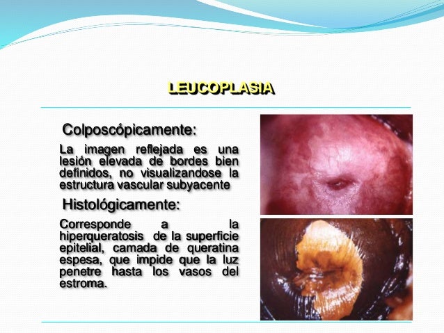 Colposcopia