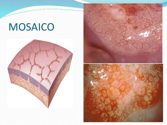 Colposcopia