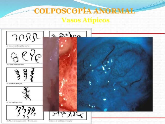 Colposcopia