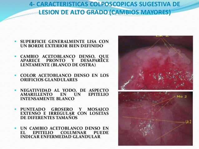Colposcopia