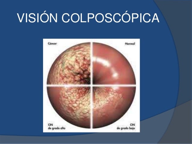 Colposcopía básica