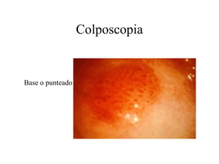 Colposcopia, principios de colposcopia. | PPT