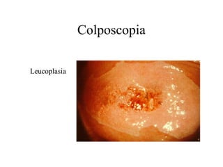 Colposcopia, principios de colposcopia. | PPT