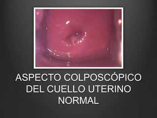 Colposcopia .pdf