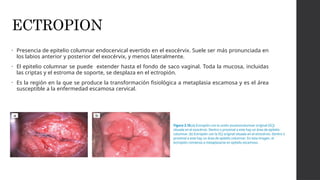 colposcopia de cervix como examen de tamizaje | PPTX
