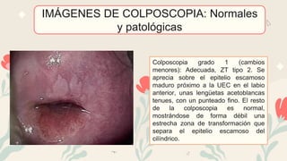 PRINCIPIOS DE COLPOSCOPIA EN GINECOLOGIA | PDF