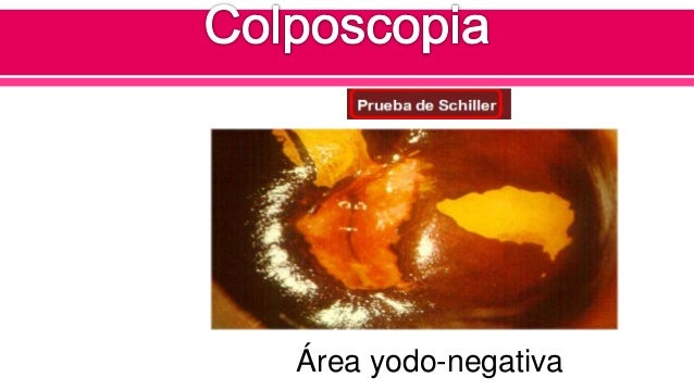 Colposcopia