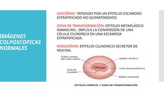 COLPOSCOPIA NORMAL Y ANORMAL y sus desafios | PPTX