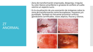 COLPOSCOPIA NORMAL Y ANORMAL y sus desafios | PPTX