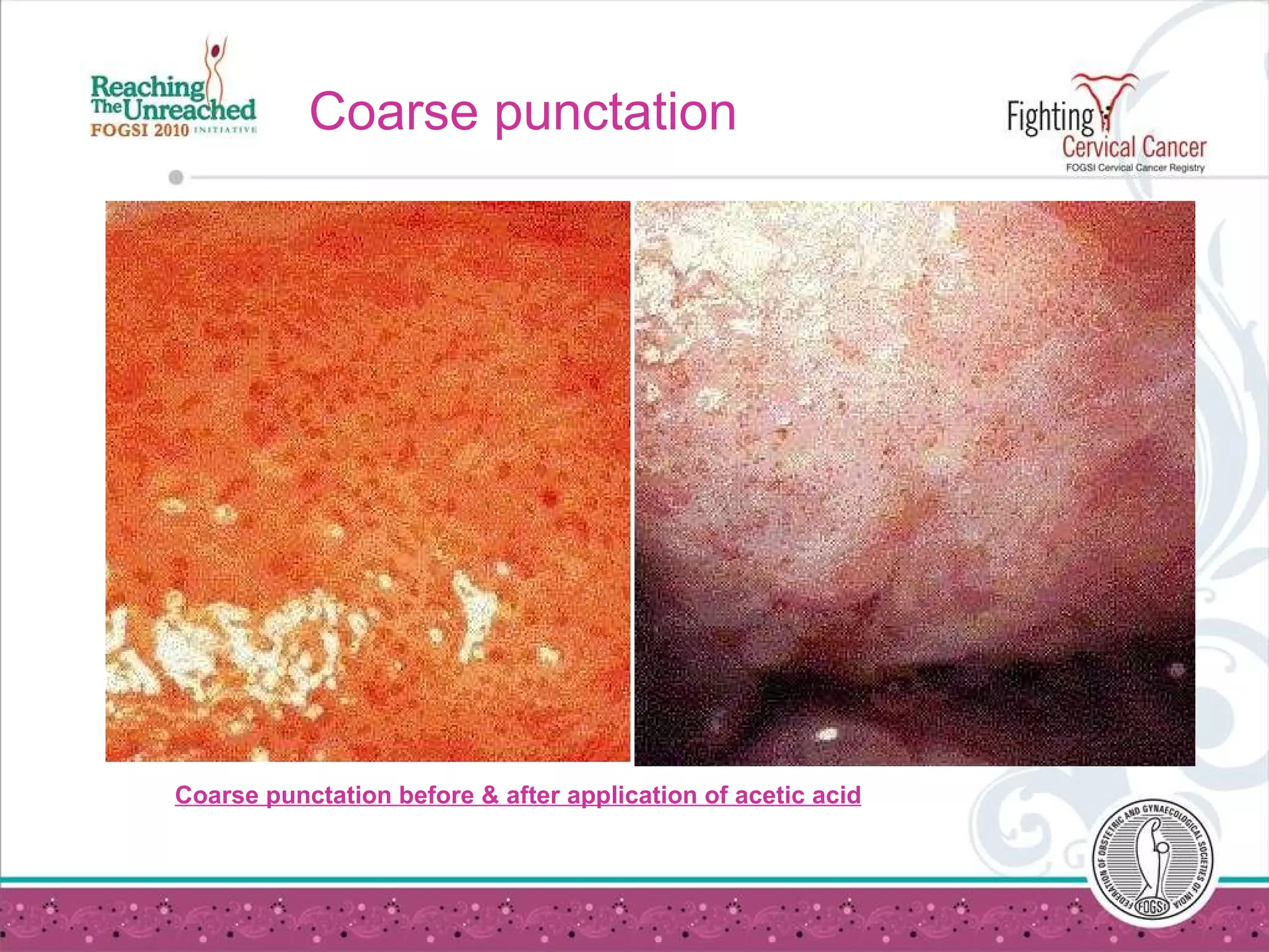 Colposcopy | PPT