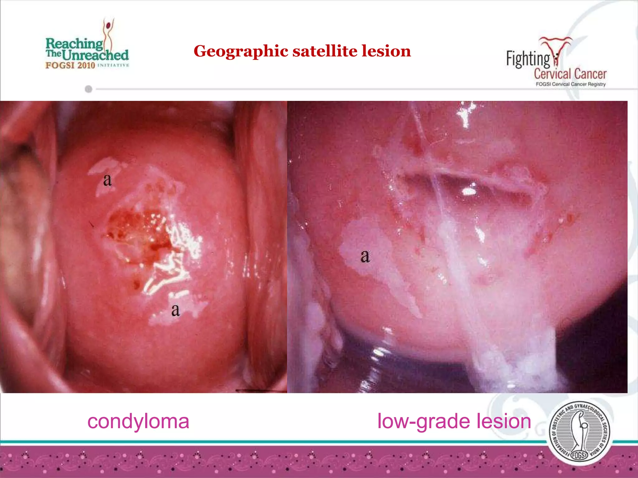 Colposcopy | PPT