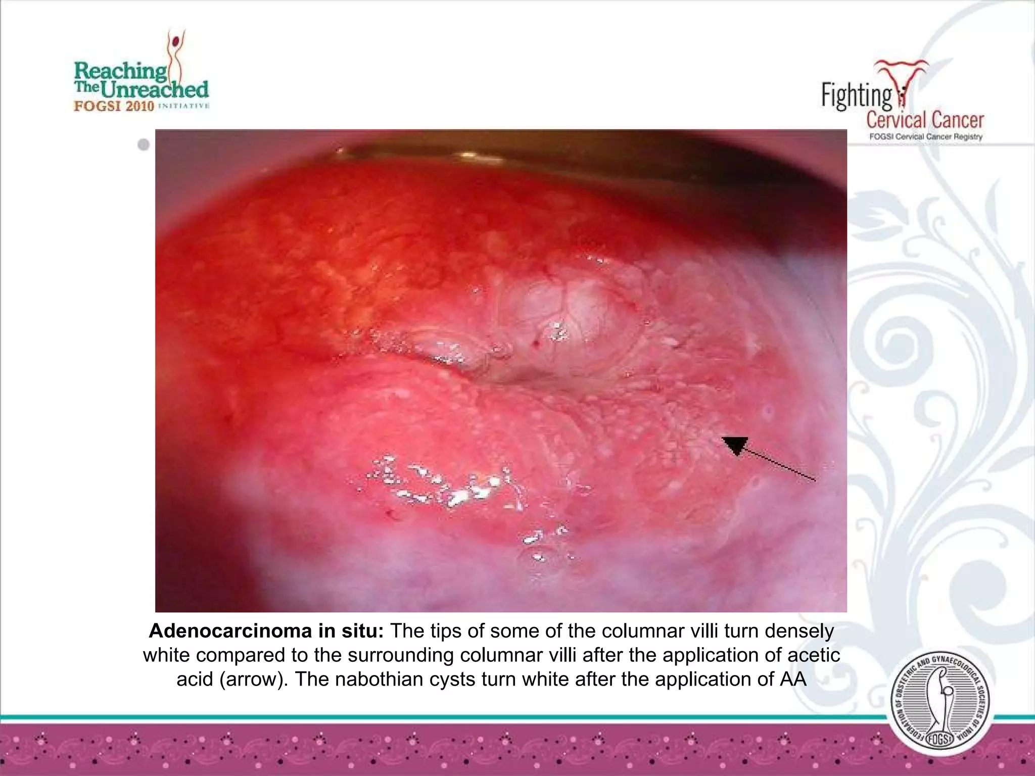 Colposcopy | PPT