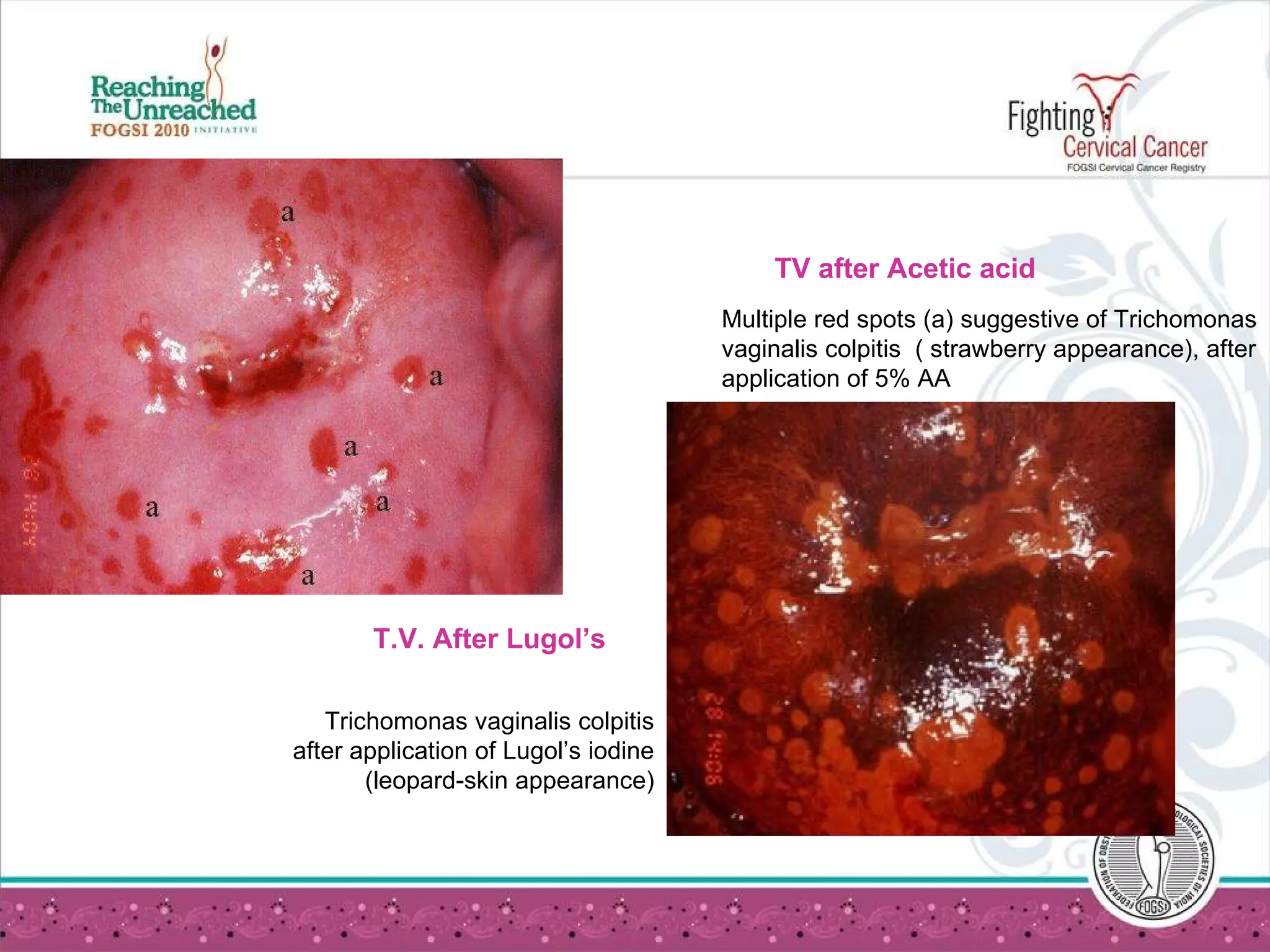Colposcopy | PPT