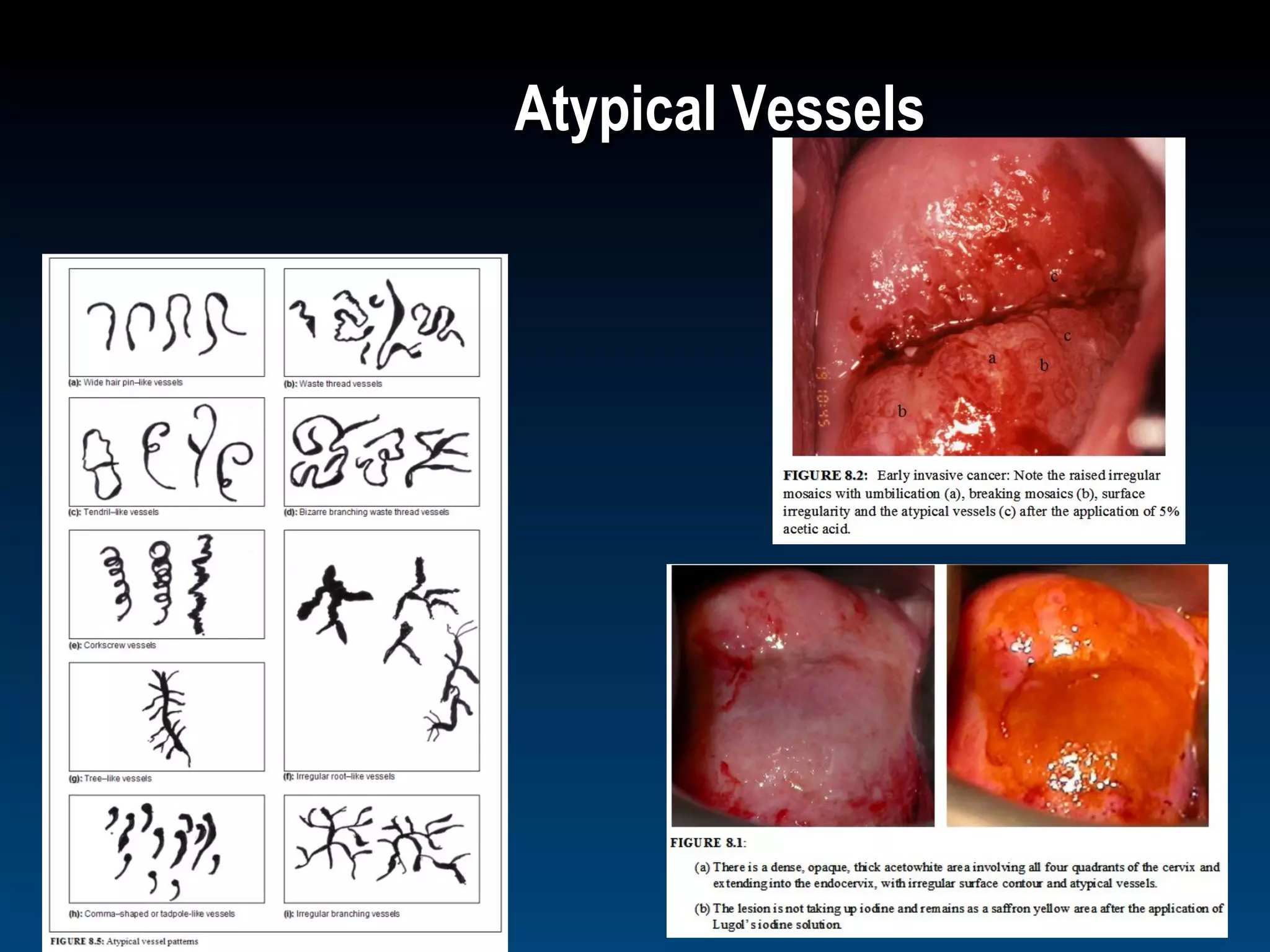 Colposcopy case studies2 | PDF