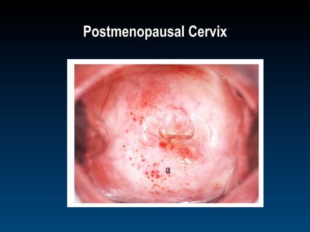 Colposcopy case studies2 | PDF