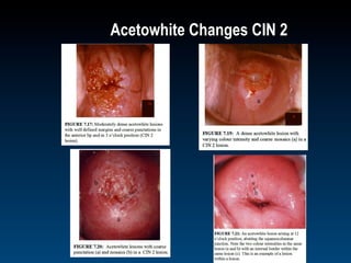 Colposcopy case studies2 | PDF