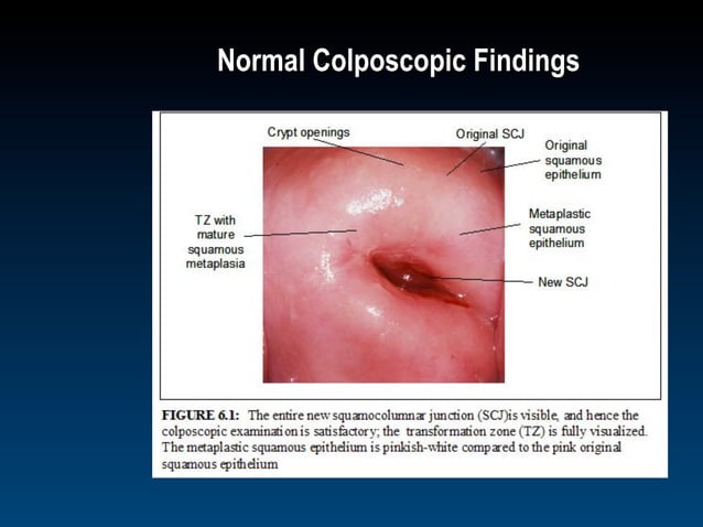 Colposcopy case studies2 | PDF