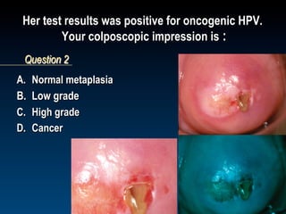 Abnormal Pap Colposcopy Biopsy