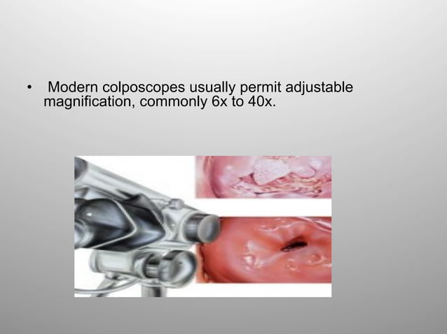 Colposcopy nstrumentation and principles on how to do 22 | PDF
